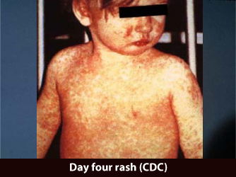 Measles: Help prevent the spread